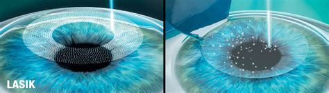 Laser Treatment Options Texas Eye Surgeons