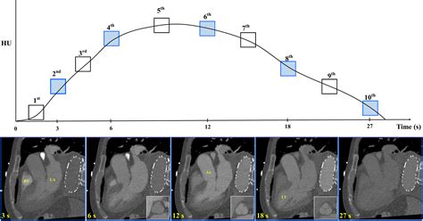 Time Resolved Cardiac Gated Computed Tomography After Endovascular Ascending Aortic And Arch