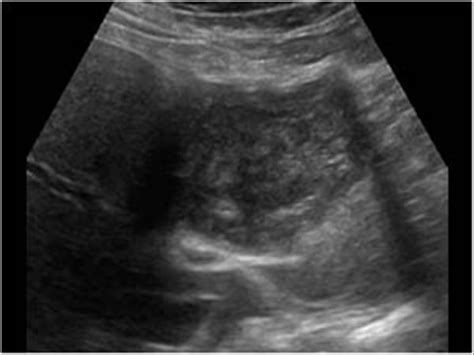 Abdomen And Retroperitoneum 11 Liver Case 115 Hydatid Cysts