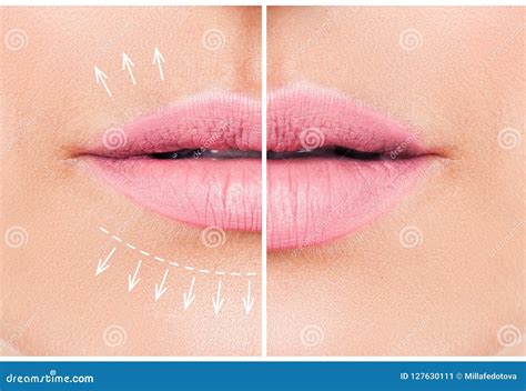 Filler Injection For Face Plastic Aesthetic Facial Surgery Doctor
