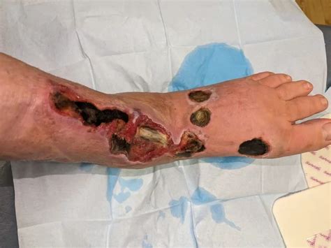 Pyoderma Gangrenosum Wpd