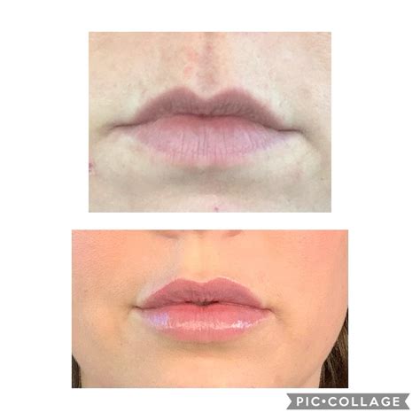 Lip Filler 2 Syringes Over 6 Months Im Really Pleased With How They