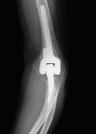 Prótesis De Codo Artroplastia De Codo Codo Doloroso O Rigido
