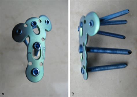 Figure 1 From Establishment Of A Three Dimensional Finite Element Model