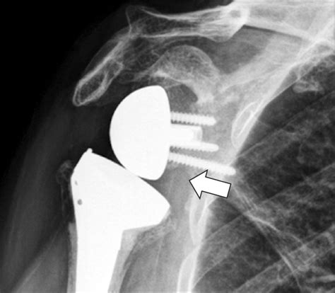 Grade Ii Scapular Notching Was Noted At Postoperative 15 Months White
