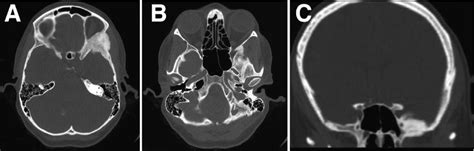 Sphenoid Bone Dysplasia