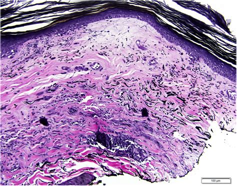 Lichen Simplex Chronicus Histology