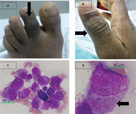 And Arrow Highlighting Right Thumb Interphalangeal Joint Arthritis