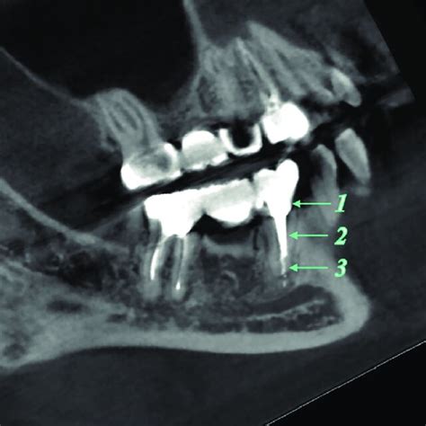 Cone Beam Computed Tomography Of The Maxillofacial Region On The Axial