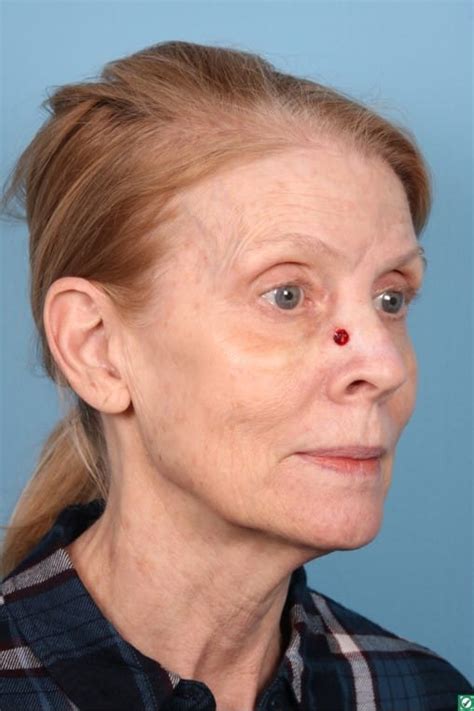 Mohs Reconstruction Before And After Treatment Pictures Dr James