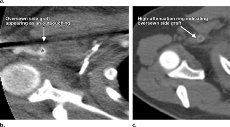 Normal Postoperative Findings In A Patient Who Had Undergone