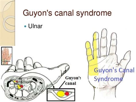 Cubital Tunnel Syndrome Ulnar Nerve Entrapment Path O