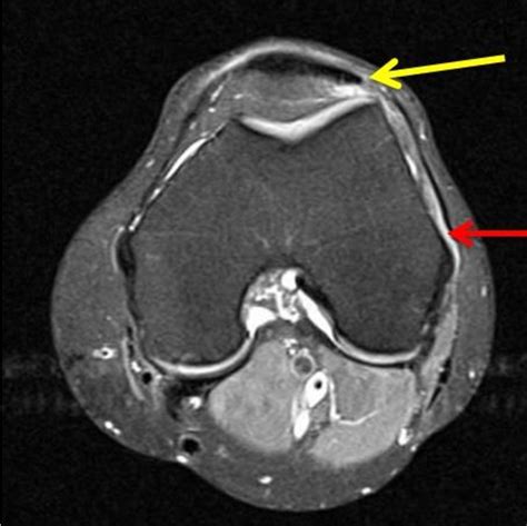 Figure 1 From The Use Of Sonographically Guided Botulinum Toxin Type A Dysport Injection Into