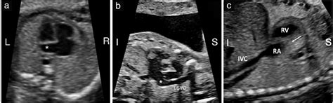 Schematic Diagrams A C And Ultrasound Cross Sectional Images B D Of Download Scientific