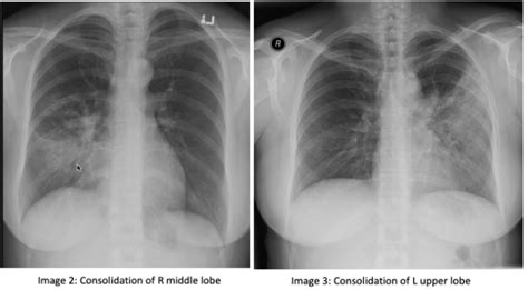 Cxr Consolidation Or Atelectasis — Maimonides Emergency Medicine