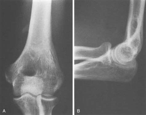 Diagnostic Imaging Of The Elbow Musculoskeletal Key
