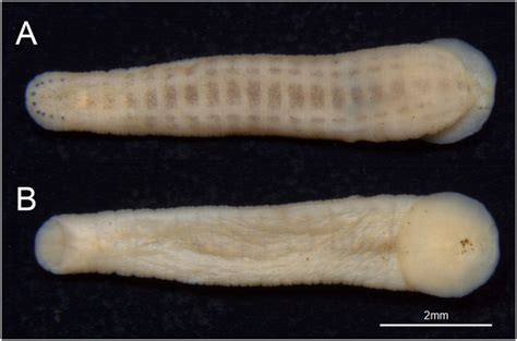 Ocular Infestation By A Juvenile Leech Myxobdella Sinanensis In Japan