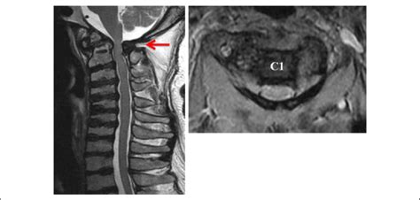 T2 Weighted Cervical Mri Left Mid Sagittal Section Right Axial