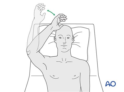 Orif Headless Screw Fixation For Partial Articular Fracture In