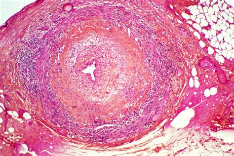 Color Duplex Sonography For The Diagnosis Management Of Giant Cell