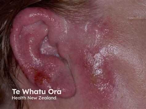 Dermnet® Cellulitis Mimics