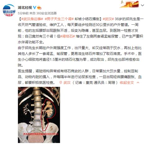 男子天生三个肾 却被小结石撂倒
