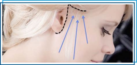 Minilifting Facial Cirujano Plástico Quito
