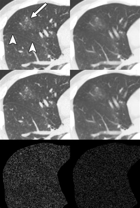 How To Clean Compression Artifacts At Bev Wood Blog