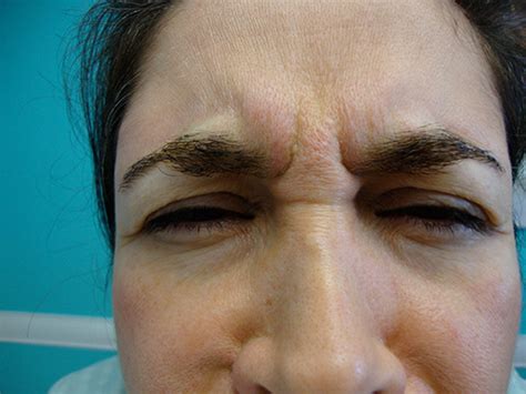 Botox Cosmetic Before And After Photos In Prince George Nova Md