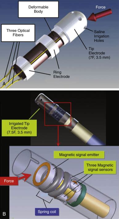 Guiding Lesion Formation During Radiofrequency Catheter Ablation Thoracic Key