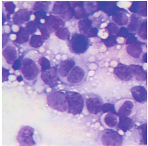 27 Round Cells From A Lymph Node Aspirate
