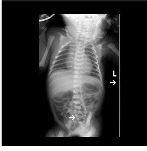 Pdf Congenital Anterior Dislocation Of The Sacrococcygeal Bone In A Newborn Semantic Scholar