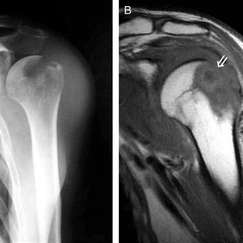 Osteomyelitis Of The Distal Tibia Caused By Staphylococcus Aureus In A