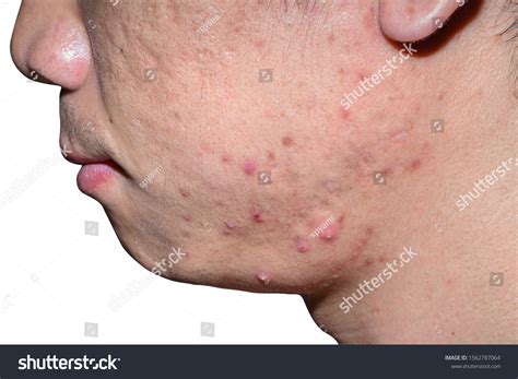 White Acne Scars On Face