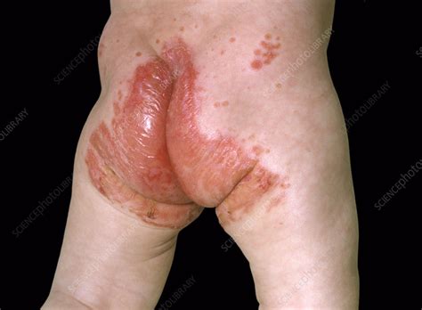 Acrodermatitis Enteropathica Stock Image C038 4498 Science Photo