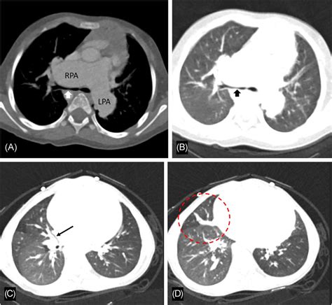 Axial Images In The A Mediastinal Window And B Lung Window