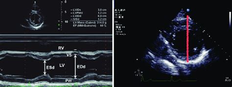Standard View Of Ejection Fraction Measurement Left Ventricular Download Scientific Diagram