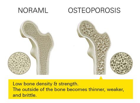 Osteoporosis Symptoms Diagnosis And Treatment Marley Drug Pharmacy