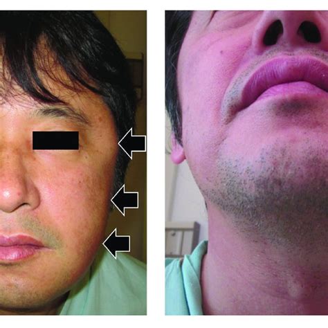 Pdf Proliferative Fasciitis Myositis Involving The Facial Muscles Including The Masseter