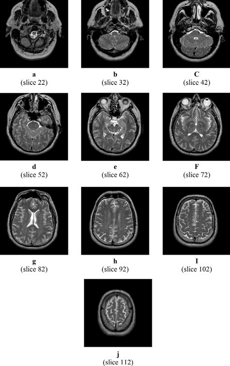 T2 Weighted Mr Brain Image Axial Download Scientific Diagram