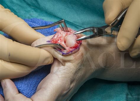 Mcp Joint Fusion Of Thumb Tension Band Wiring Technique Surgical