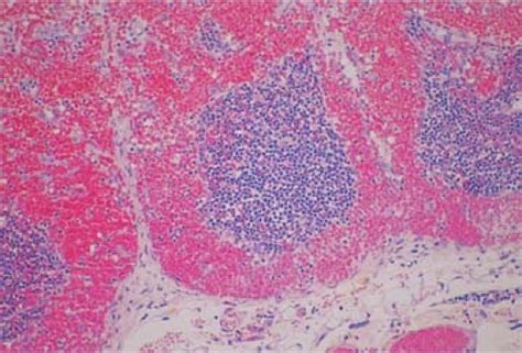 Vascular Transformation Of Sinuses Basicmedical Key