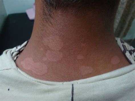 Pityriasis Versicolor Creme Solaire 100 Quality Th