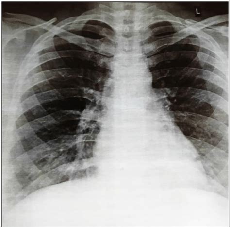 Chest X Ray Of The Patient With No Any Abnormality Download