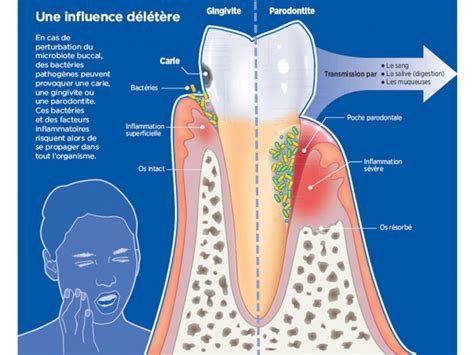 Gare Au Déséquilibre Du Microbiote Buccal