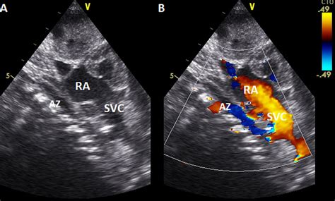 Echocardiography 2d And Color Doppler A B Respectively Subcostal