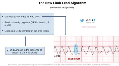 1 Todays 🧵is About Vt Versus Svt With Aberrancy The Aim Of This