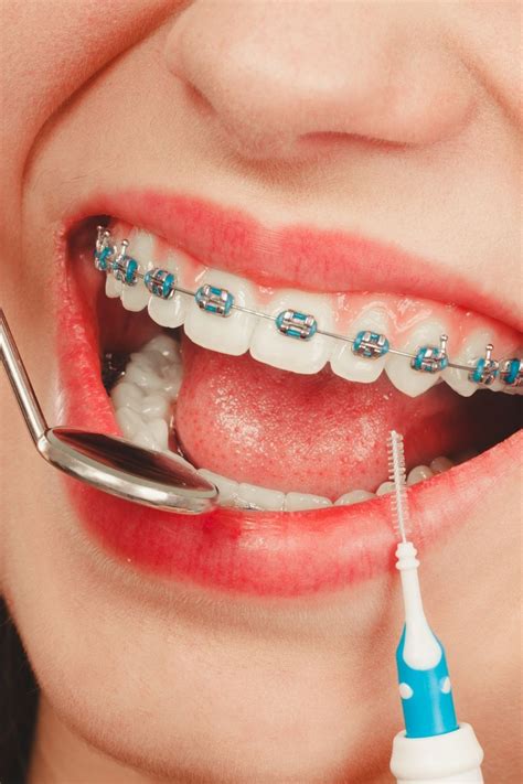 Invisalign Braces Artofit