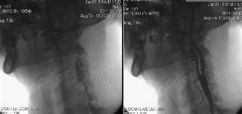 Stenting Of The Left Internal Carotid Artery With A Graft Covered Stent