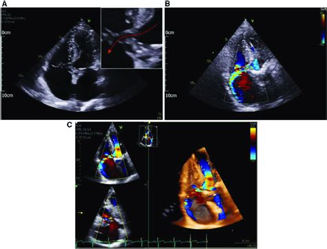 A Apical Four Chamber View Demonstrating A Hypoechoic Tract Between